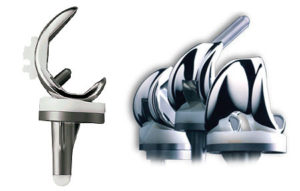 Total Knee Replacement (Arthroplasty) | Knee Specialist in Mumbai | Dr ...