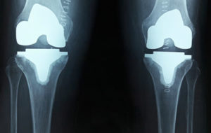 Bilateral Total Knee Replacement | Orthopaedic Surgeon in Mumbai | Dr ...