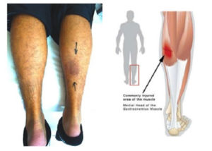 Muscle Injuries: Strains Management | Orthopaedic Doctor in Mumbai | Dr ...