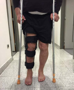 After High Tibial Osteotomy (HTO) Surgery | Knee Surgeon in Mumbai | Dr ...