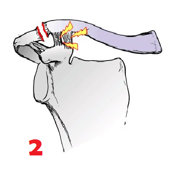 AC (Acromio-Clavicular) Joint Disruption | AC Joint Injury ...