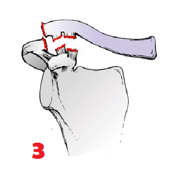 AC (Acromio-Clavicular) Joint Disruption | AC Joint Injury ...