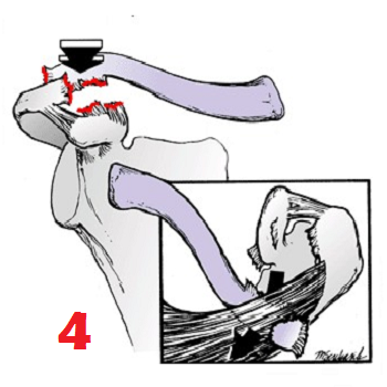 AC (Acromio-Clavicular) Joint Disruption | AC Joint Injury ...
