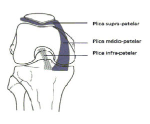 Knee Plica (Synovial) Syndrome: Symptoms, Causes, Treatment ...