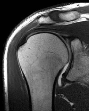 Rotator Cuff Tendinopathy Mri
