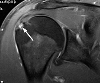 Arthroscopic Subacromial Decompression for Impingement Syndrome of the ...