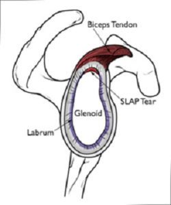 Arthroscopic Repair of SLAP Tears: Examination & Treatment ...