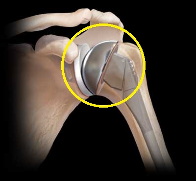 Types of Shoulder Replacement Surgery | Shoulder Specialist in Mumbai ...
