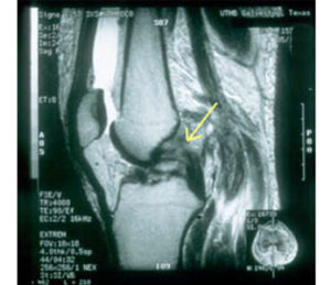 PCL Injury: Posterior Cruciate Ligament (PCL) Tear & Reconstruction ...