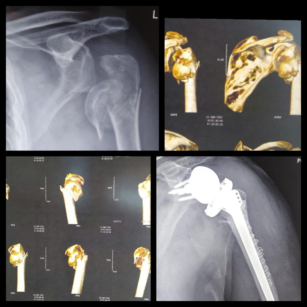 Dr. Amyn Rajani Performs Reverse Shoulder Arthroplasty for Proximal ...