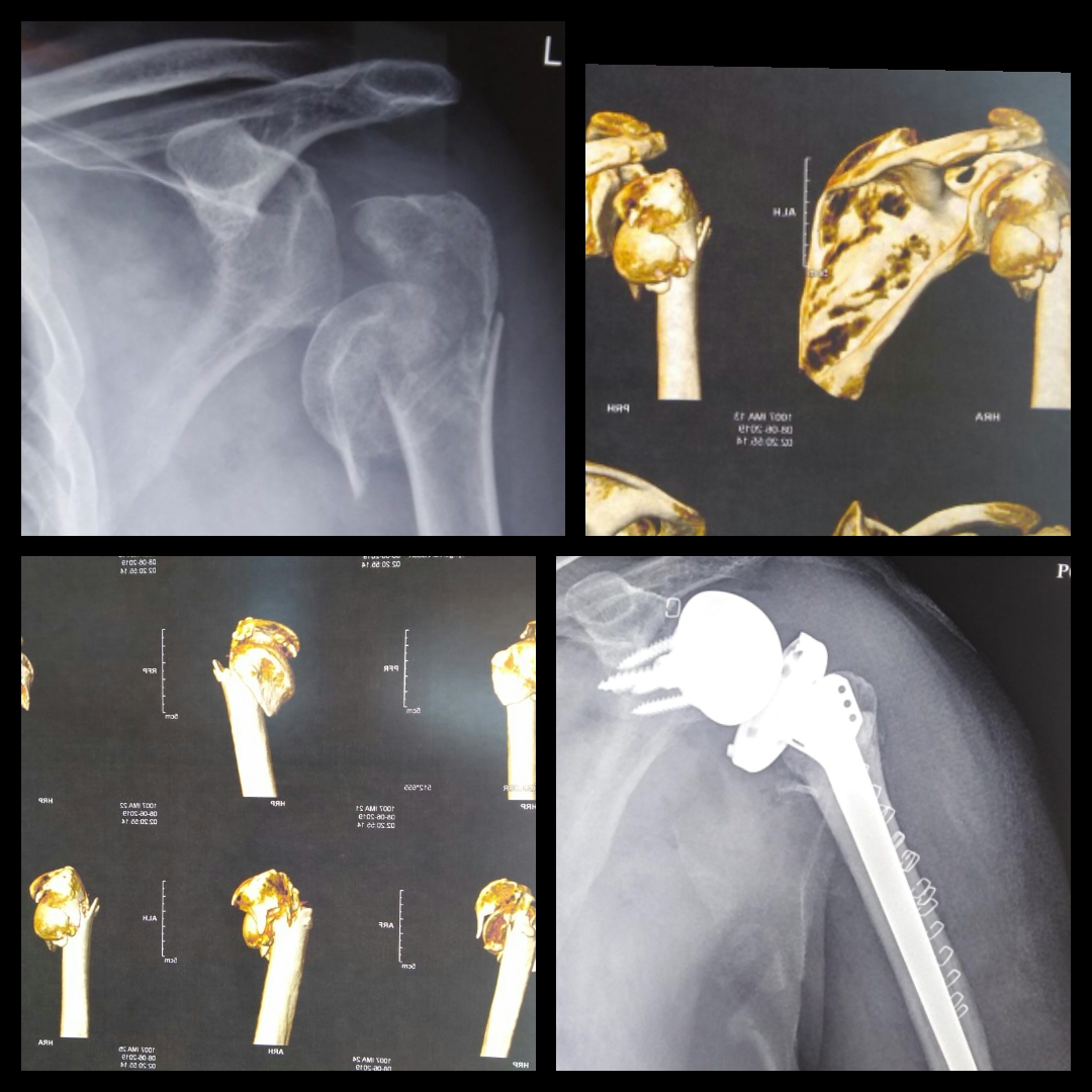 Reverse Total Shoulder Arthroplasty In Proximal Humerus Fractures With