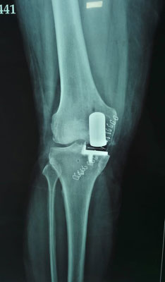 Partial Knee Replacement Surgery Procedure | Knee Specialist in Mumbai ...