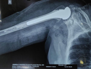 Total Shoulder Replacement Surgery Pictures | Shoulder Surgeon in ...