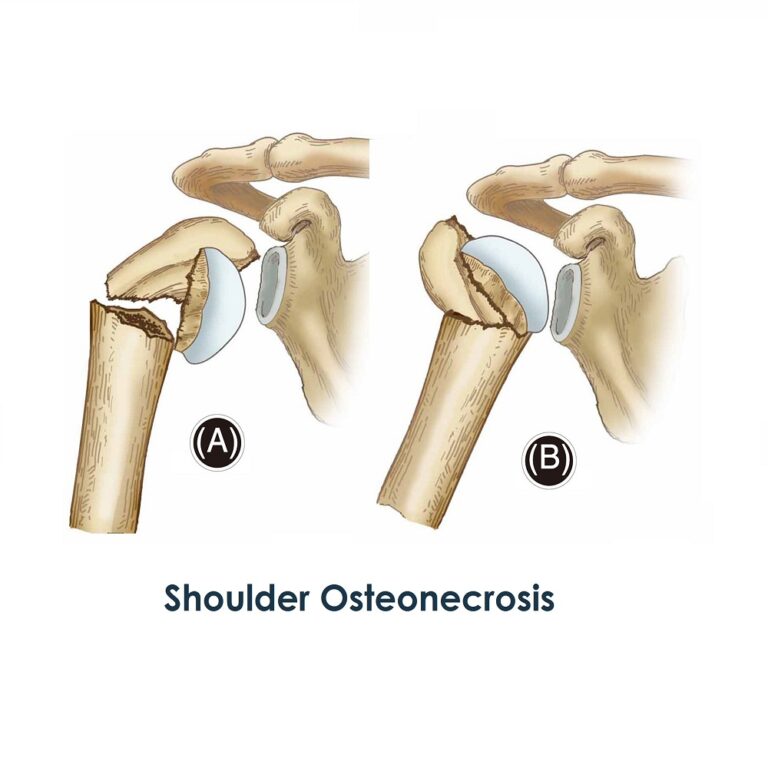 Arthroscopic Shoulder Surgery - Fast Recovery, Smaller Scars - Dr. Amyn ...